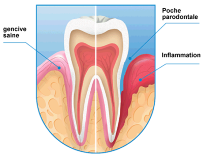 Diagnostic et traitement de la maladie parodontale à Marseille