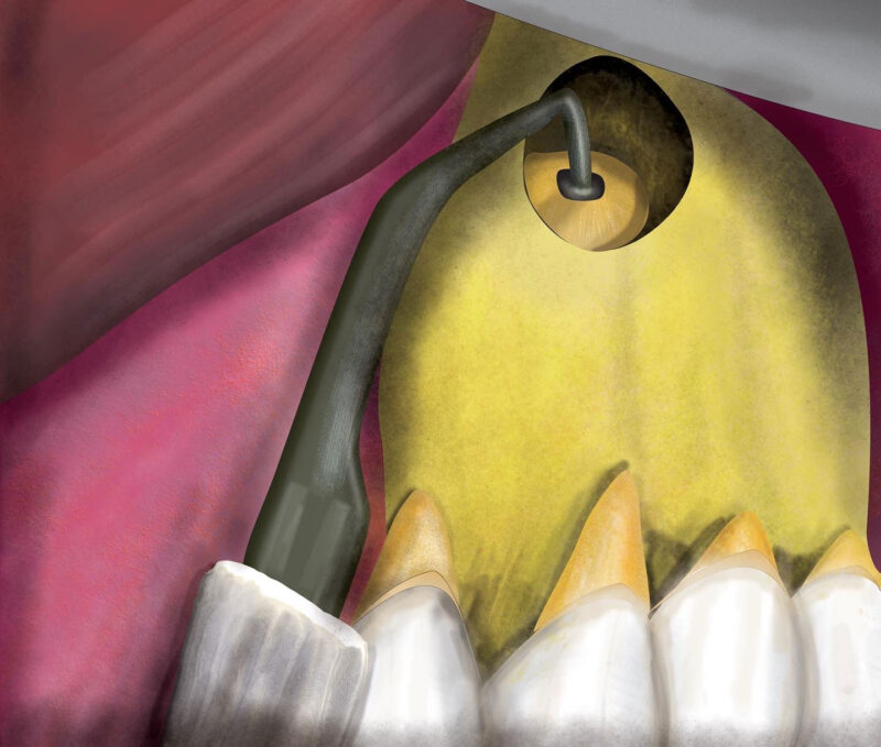 Résection apicale - Endodontiste exclusif Marseille - Dr Bordone