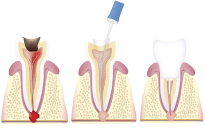 Traitement canalaire (dévitalisation) - Endodontiste exclusif Marseille